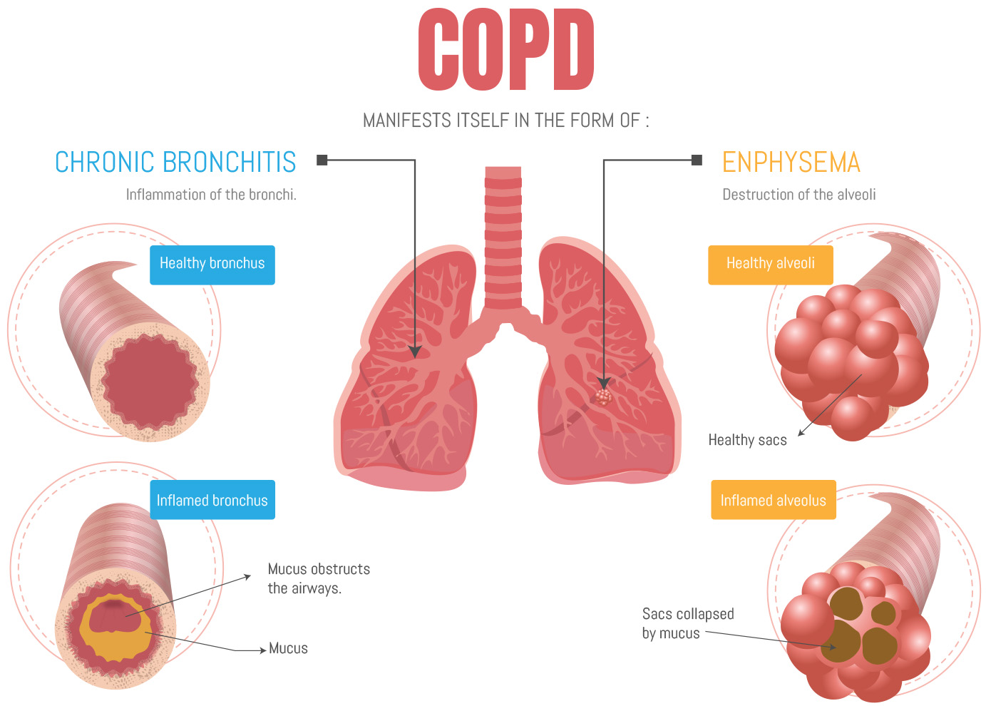 End-Stage COPD Hospice Care | Customized Comfort Care Plans